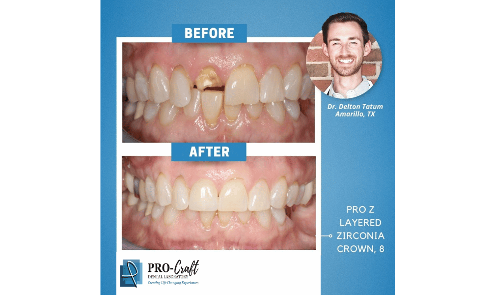 Tips for Aesthetic Anterior Crowns Success